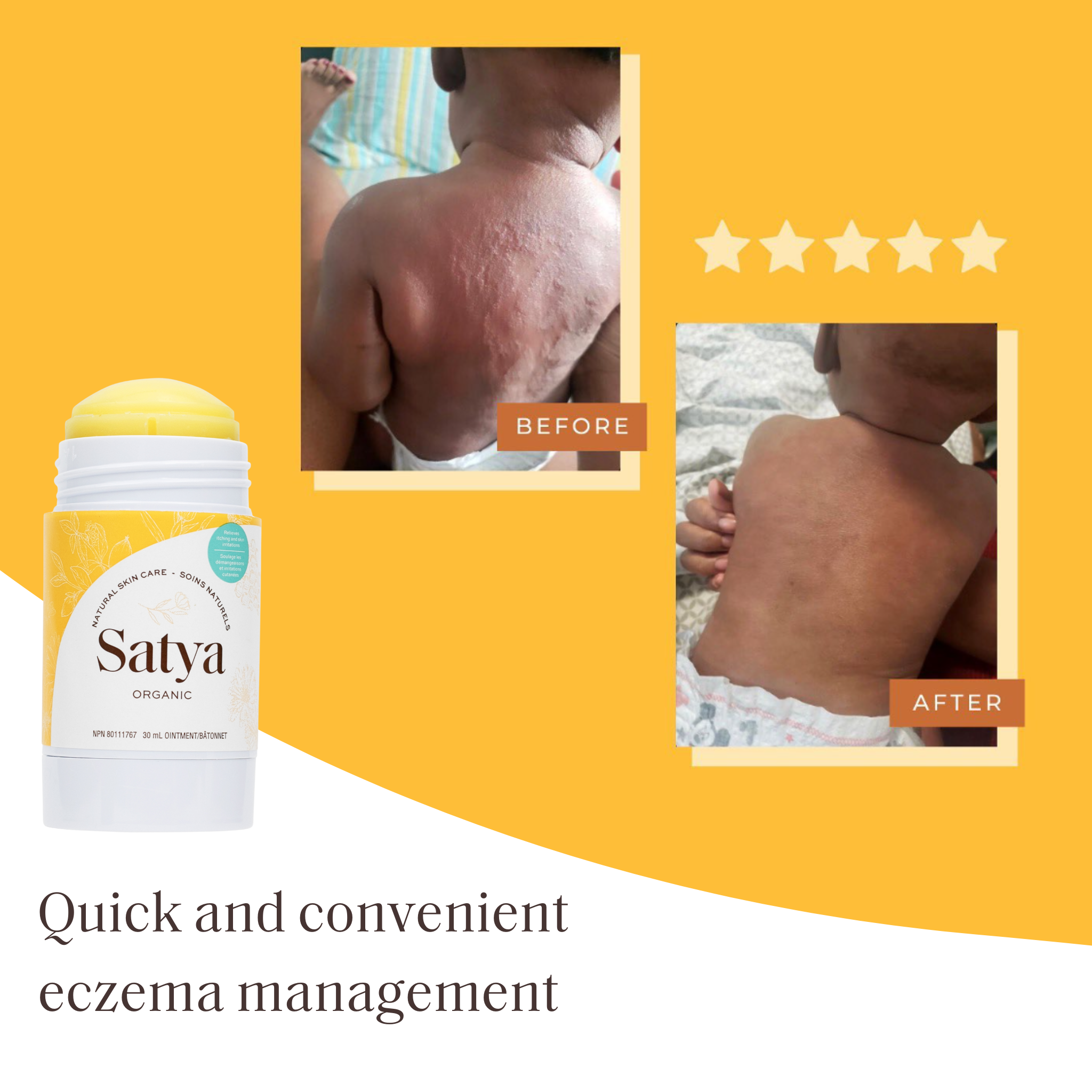 Eczema Easy Glide Stick | Satya Organic – Satya Organic Canada